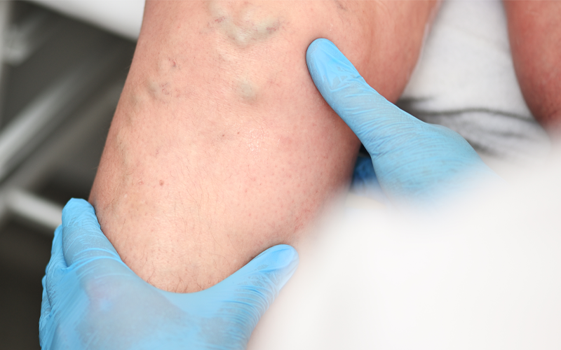 O que são varizes e quais as melhores formas de tratá-las? - Supera Farma